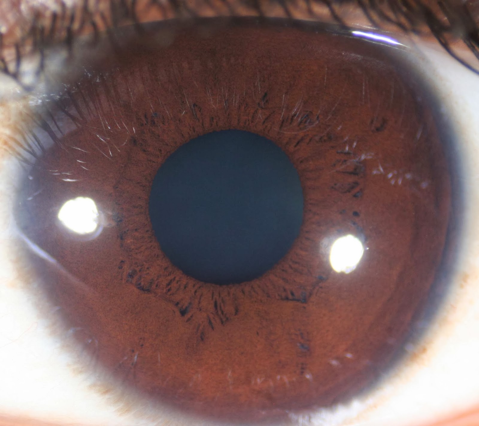 Modern & Multidimensional Iridology: Crypts at Pupillary Zone ...