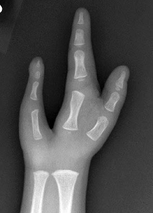 Ulnar Sided Cleft Hand | Congenital Hand and Arm Differences ...