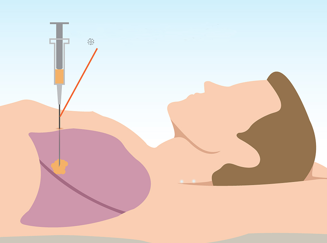 Drrattawachir การเจาะปอดผ่านทางผิวหนัง Transthoracic Needle Biopsy