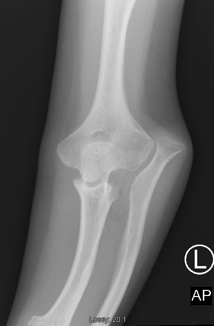 Multiple Hereditary Exostosis- Its Not Always about the X-rays ...
