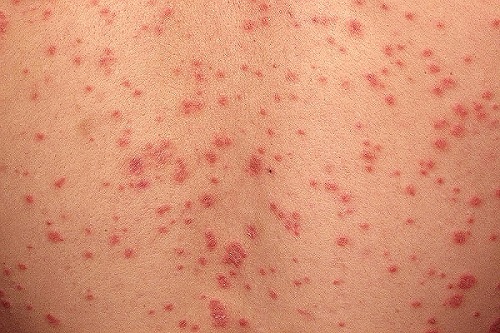 🖐 Remedios Caseros para la Psoriasis de Gota | Remedios Naturales para ...