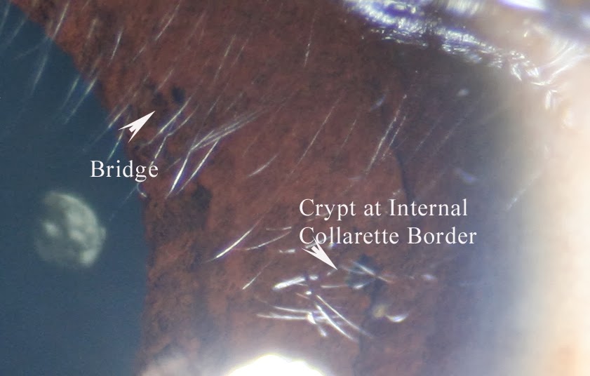 Modern & Multidimensional Iridology: Signs at Internal Collarette ...