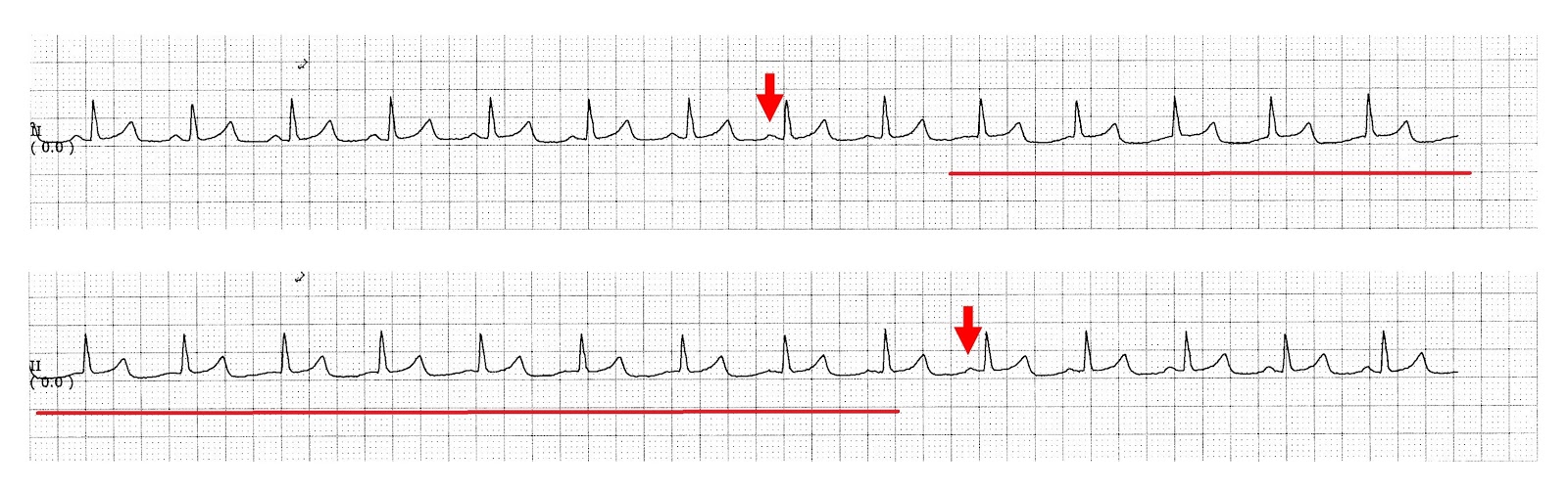 ECG Channel: Sinus Arrhythmia
