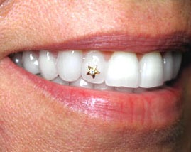 Get your smile on!: Gold Dental Inlays