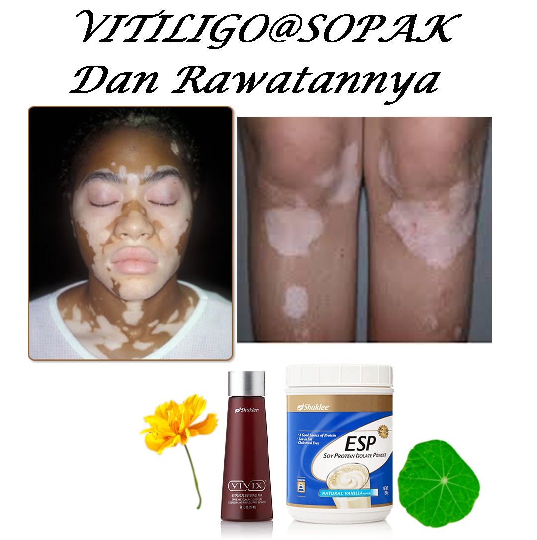 VITILIGO : Penyakit Sopak Dan Rawatan Alternatifnya - amynorami.com
