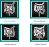 SABE USTED QUE ES UN ESTOMA?: CLASIFICACION DE LAS OSTOMIAS