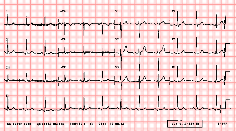 telemedicina EKG: frecuencia metodo del 1500