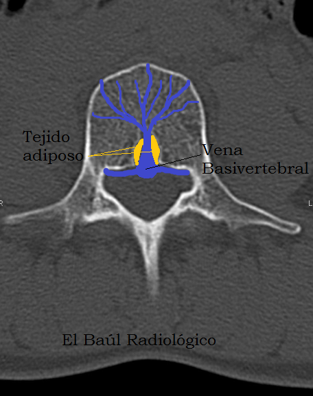 El Baúl Radiológico: VENAS BASIVERTEBRALES. (Basivertebral Veins: CT ...