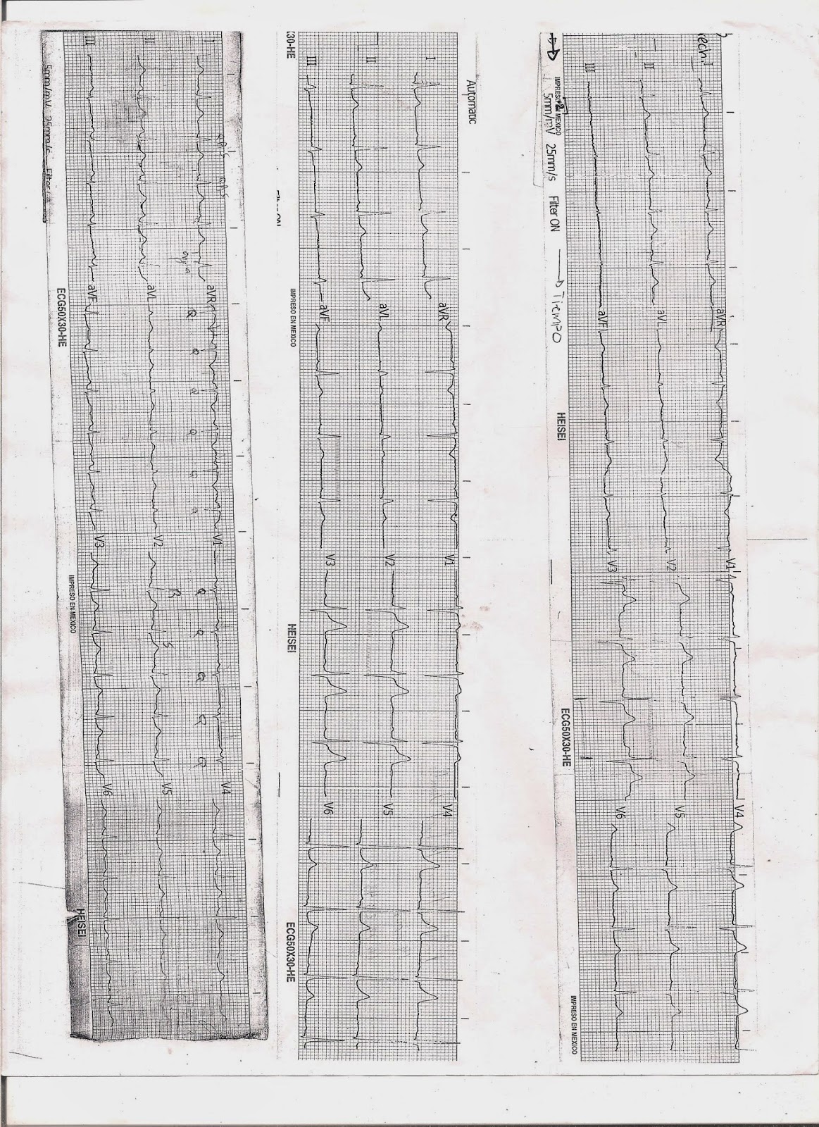 FISIOLOGIA: ELECTROCARDIOGRAMA Y LOS CINCO EJEMPLOS DE ELECTROCARDIOGRAMAS