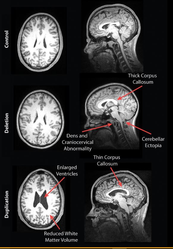 Epiphany: Autism MRI