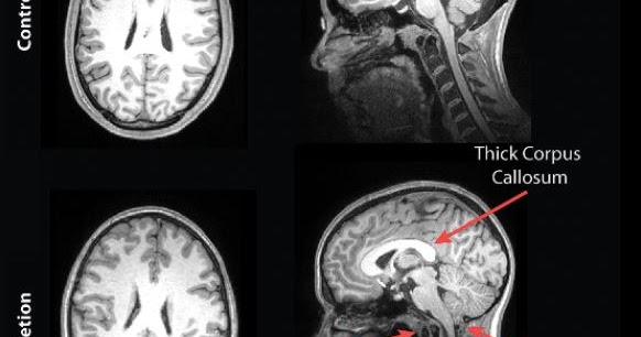 Epiphany: Autism MRI
