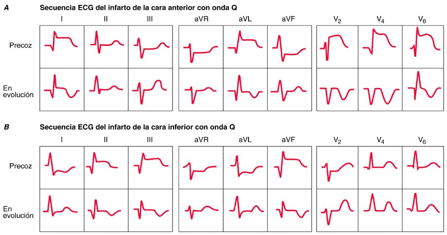 INFARTO AGUDO MIOCARDIO: INFATO AGUDO MIOCARDIO