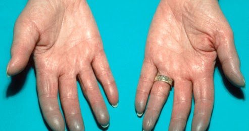 À Beira Lethes: Acrocianose