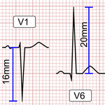 ELECTROCARDIOGRAFÍA BÁSICA PARA ENFERMERÍA: HIPERTROFIAS