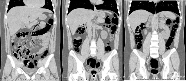 CASIMIRO RADIACTIVO: ESTUDIO DE COLONOSCOPIA VIRTUAL POR TC - VIRTUAL ...