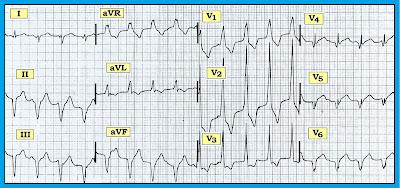 ECG Interpretation: ECG Blog #134 (Ventricular Tachycardia – VT – AIVR ...