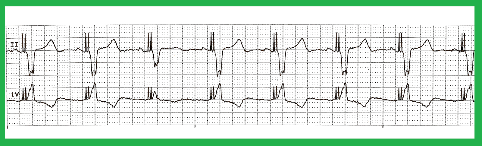 Float Nurse: Various Biventricular Paced Rhythms