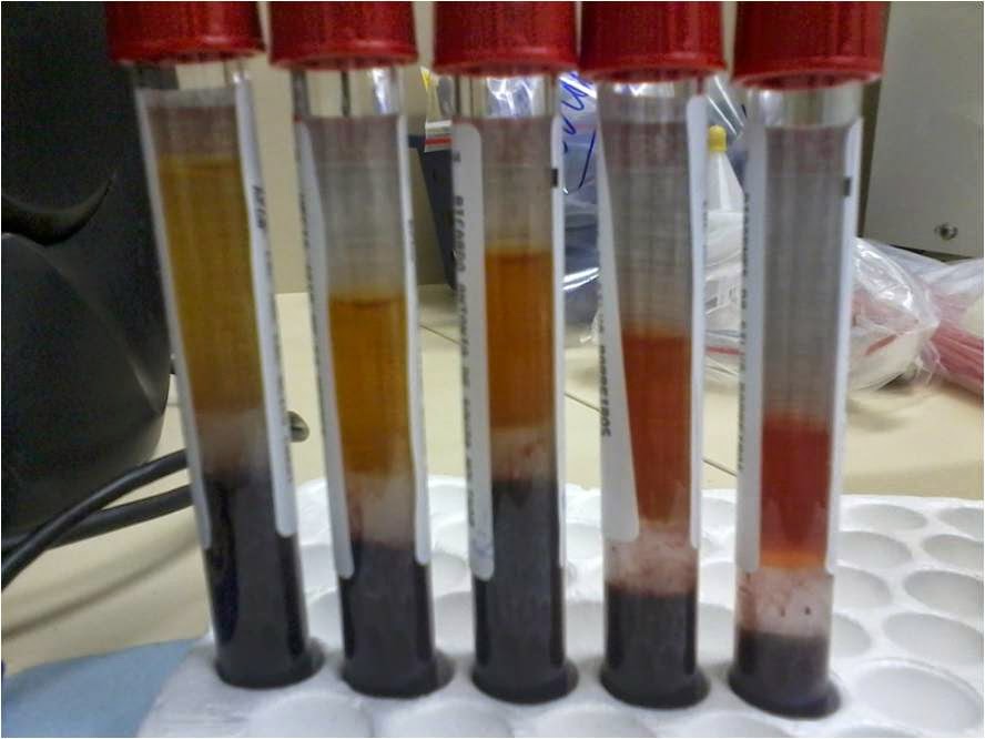 Bio-Trabalho: Hemólise