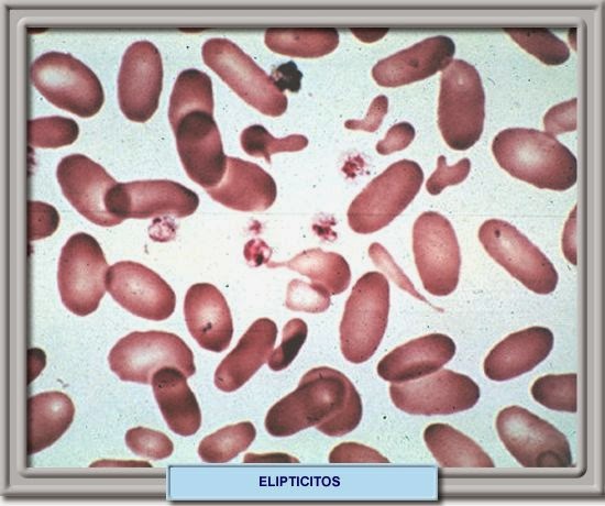 Hematologia: Línea Eritroide Anormal