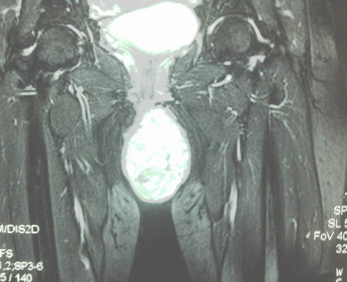 VIETNAMESE MEDIC ULTRASOUND: CASE 395: MAJOR LABIA TUMOR, Dr PHAN THANH ...