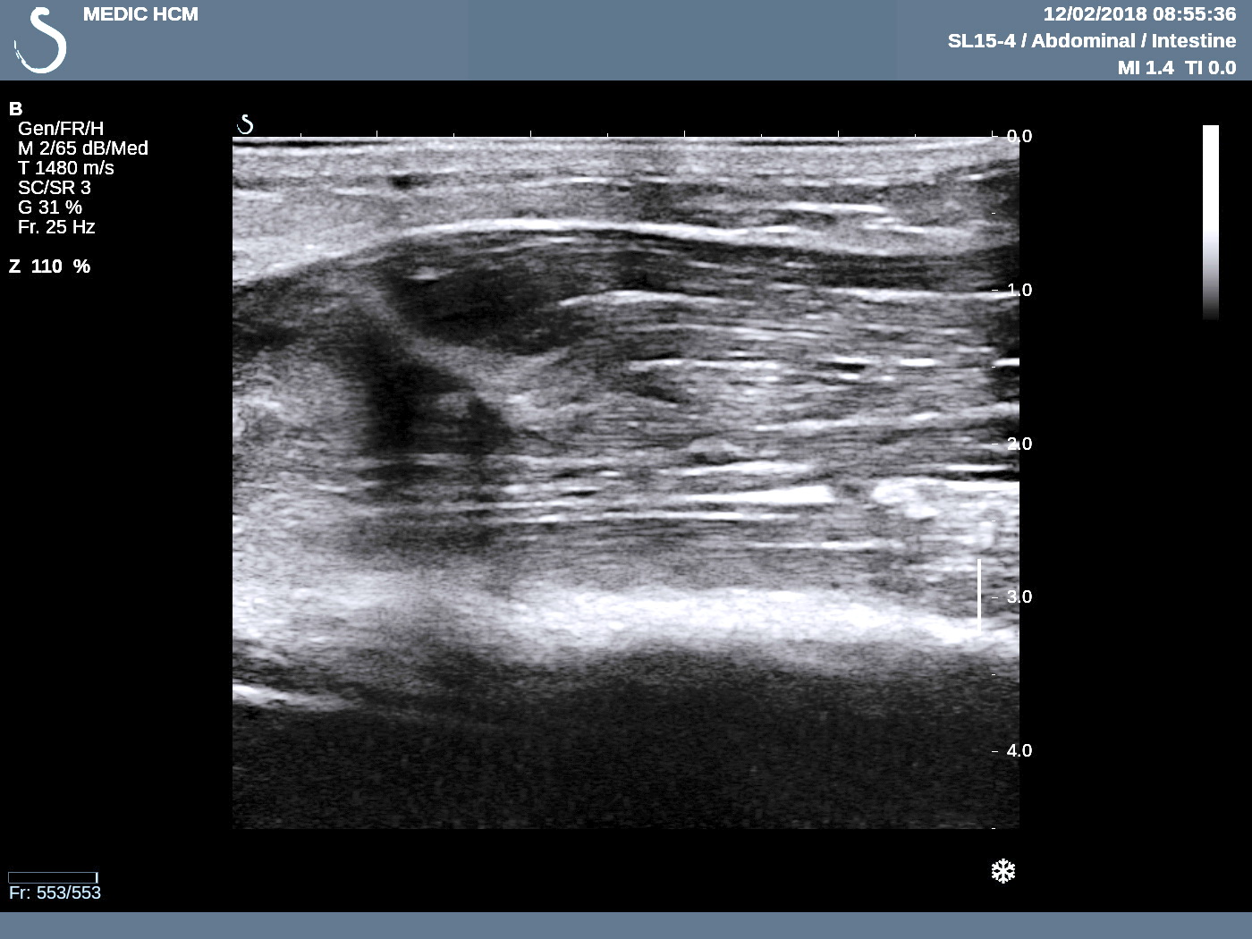 VIETNAMESE MEDIC ULTRASOUND: CASE 478: POPEYE’ SIGN of BICEPS MUSCLE ...