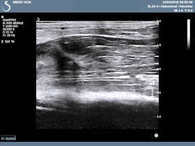 VIETNAMESE MEDIC ULTRASOUND: CASE 478: POPEYE’ SIGN of BICEPS MUSCLE ...