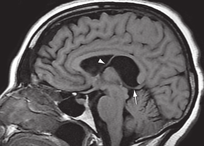 Cavum Septum Pellucidum-Mayo Radiology