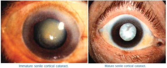 Medical Stuff: Lensa Mata dan Katarak