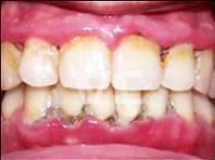 Crystal Lake Dental's Hot topics: A Gum disease form causing severe bad ...