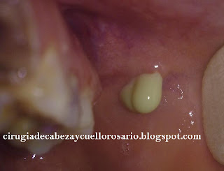 Cirugía de Cabeza y Cuello Rosario: PAROTIDITIS AGUDA