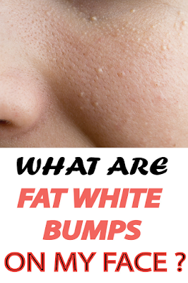 What are white fat bumps on my face ? | HEALTHYLIFE
