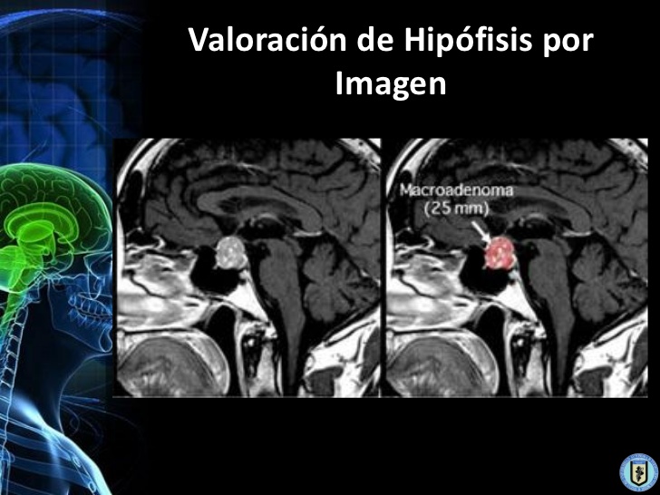Endocrinología Managua Adenoma De Hipófisis O Tumor Pituitario