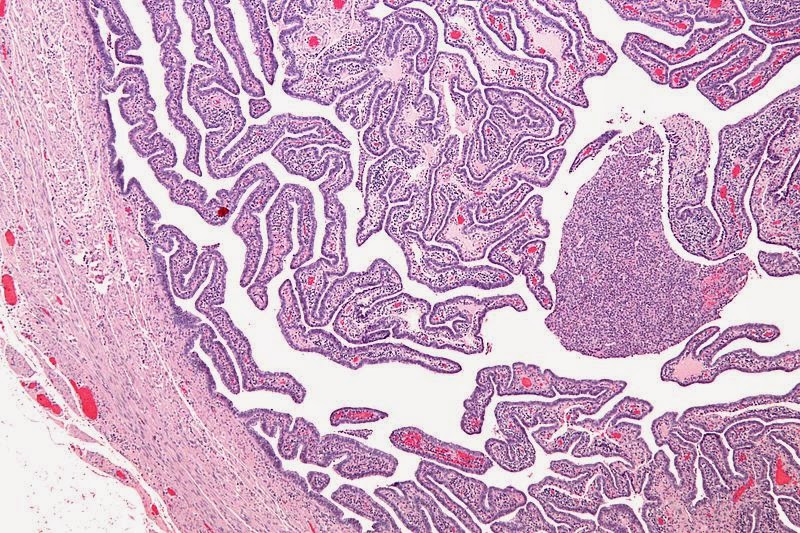 Agustina Ocampo - Patología B 2014: Salpingitis aguda