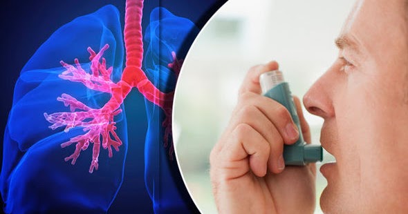 Penyebab Sakit Asma dan Cara Mengatasinya