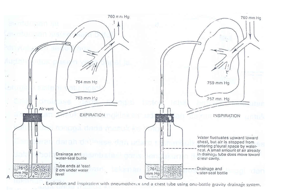 TENTANG JANTUNG: PROSEDUR PEMASANGAN DAN PENCABUTAN WSD