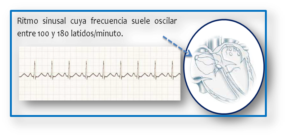 Amanecer Cada Día: ELECTROCARDIOGRAMA ANORMAL - ARRITMIAS ...