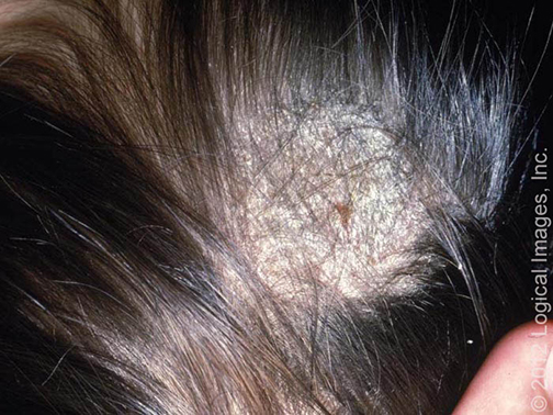 ASK DIS: Treatment of Tinea Capitis