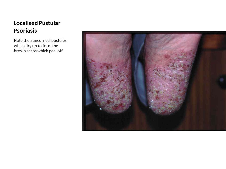 Dermatopathology Made Simple - Inflammatory: Pustular Reaction Pattern