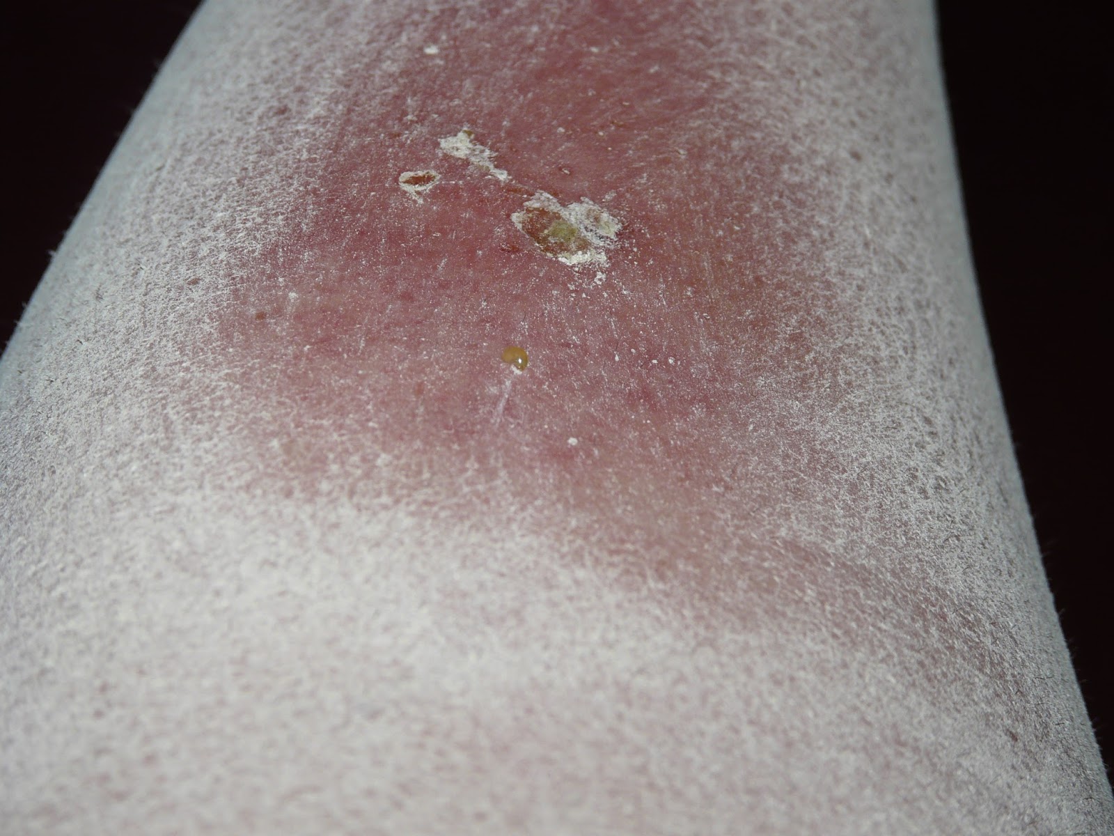 The "Secret" is Gratitude: Latest Parasite Update Video - Leg Sores ...