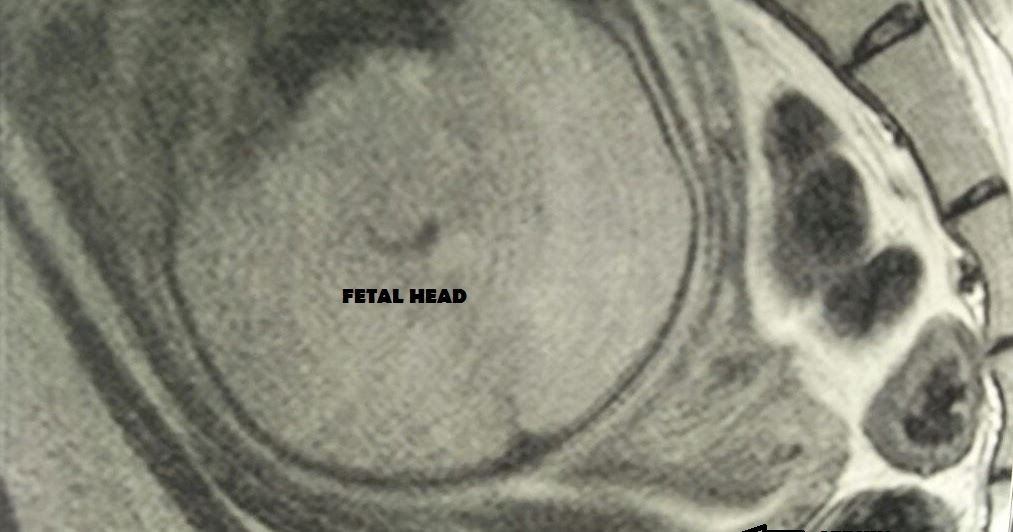 Journal Of Postgraduate Gynecology And Obstetrics Spontaneous Conception