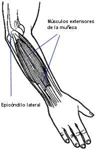 MARLINPADEL.COM: EPICONDILITIS (CODO DE TENISTA)
