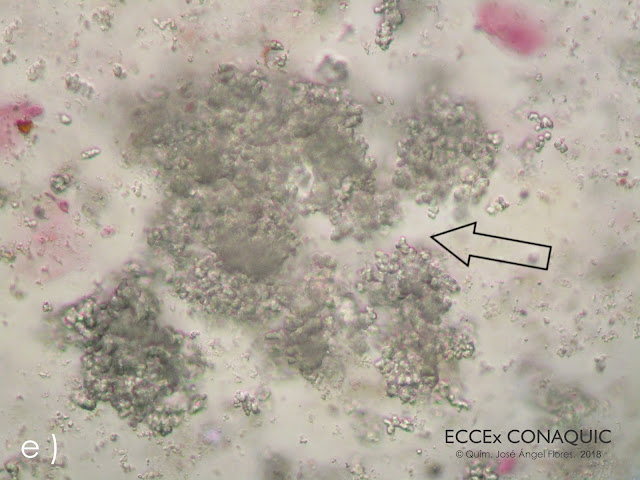 Caso UR-mayo-18 (Enfoque: cristaluria)