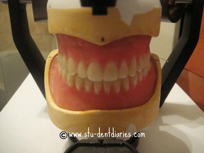 Stu-DENT Diaries: Removable Prosthodontics: Complete Dentures