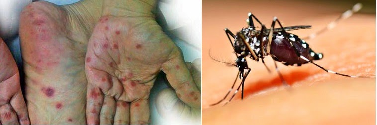 mengenal Demam Berdarah Dengue dan gejalanya | Berbagi Kiat Sehat