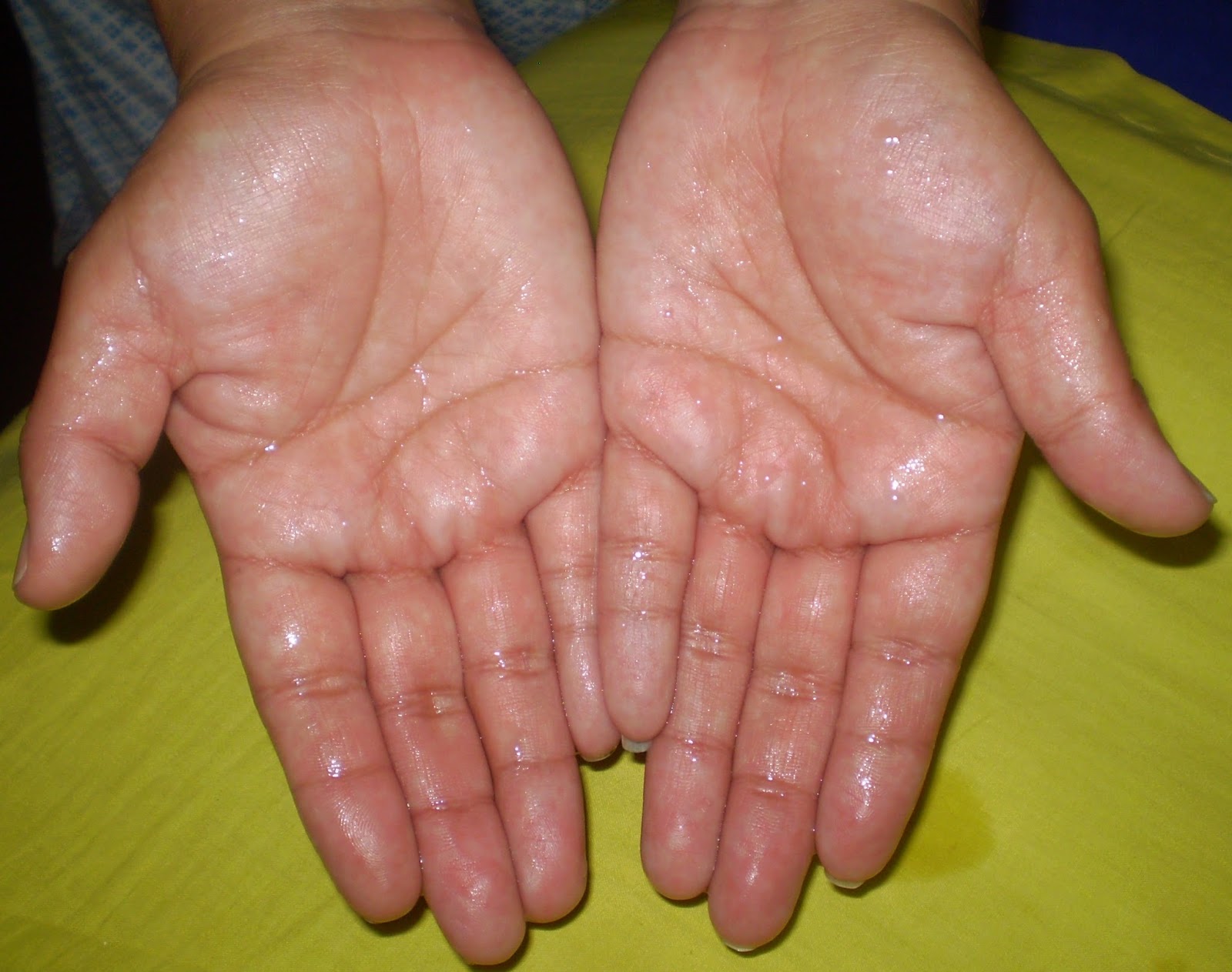 Medicina y Belleza: Hiperdrosis: Sudoración excesiva