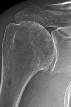 Shoulder Arthritis / Rotator Cuff Tears / Shoulder Pain : Chondrolysis ...