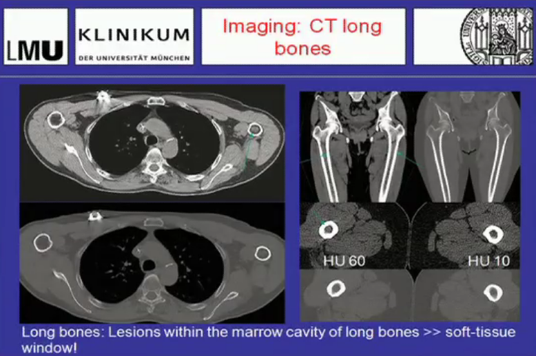 rsna: multiple myeloma