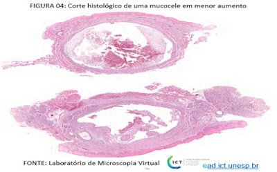 Atlas virtual de histologia e patologia: [CC II: #4] MUCOCELE