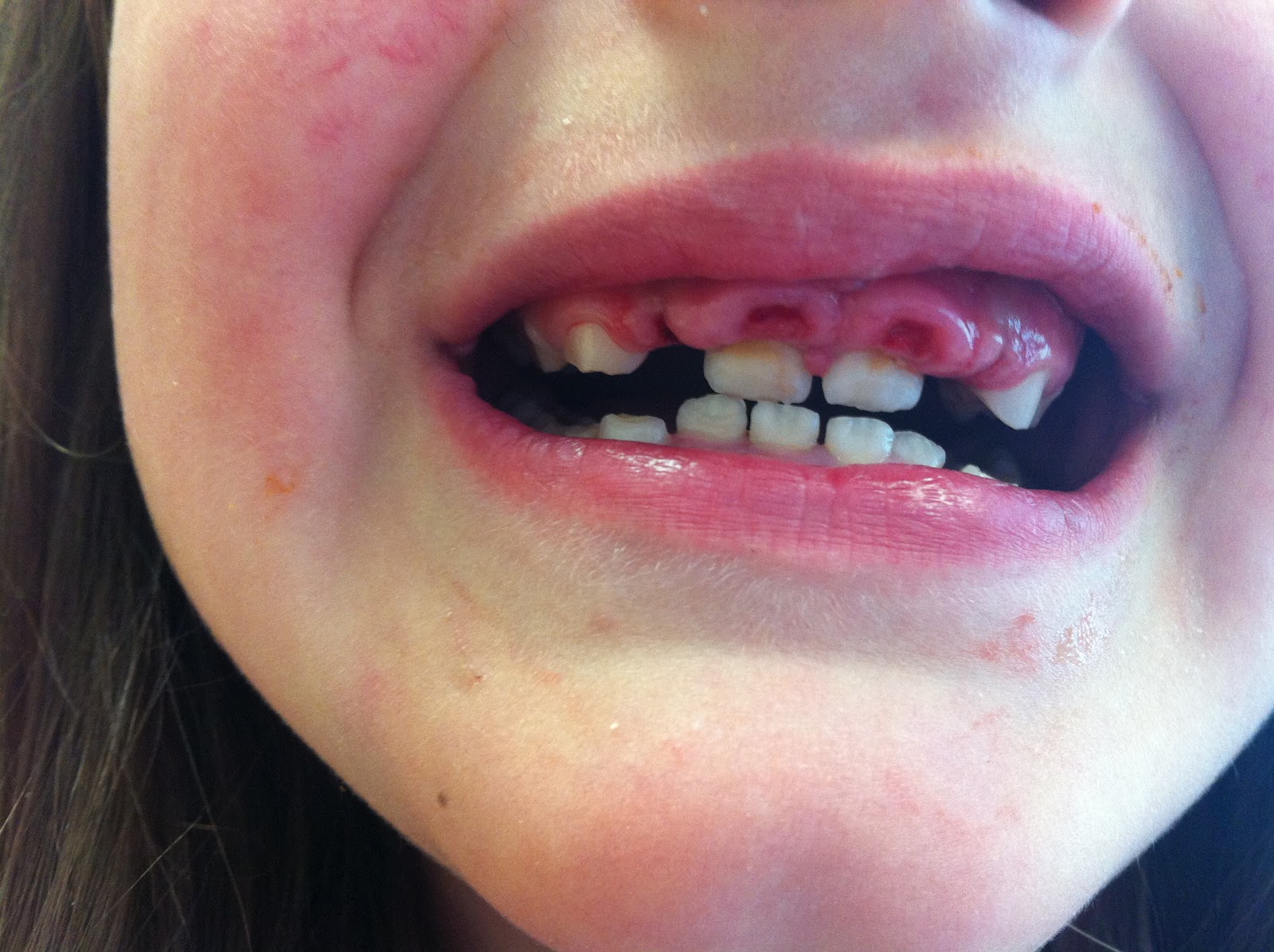 Two Rows Of Teeth