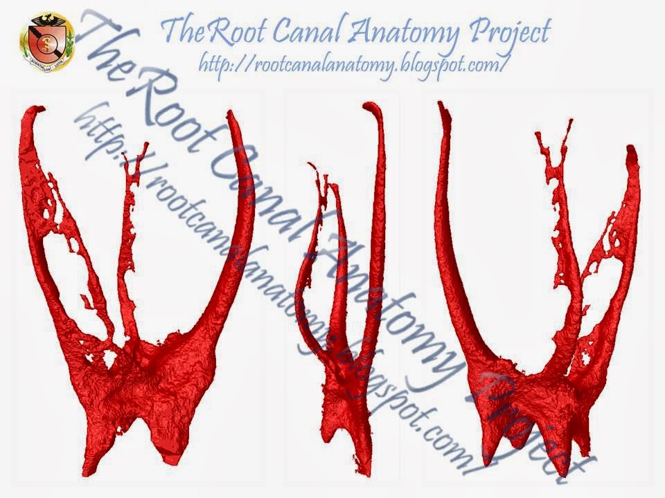 The Root Canal Anatomy Project: Maxillary First Molar: MB2
